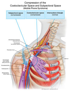 The Subclavius Muscle - The Single Most Super Contracted Muscle of ...