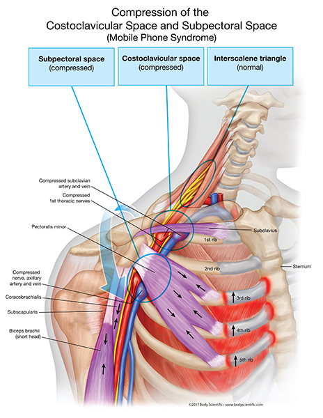 What is the cause of the compression of your thoracic outlet ...