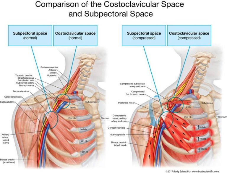 What Type of Thoracic Outlet Syndrome Do You Have and... Why Is This Even Important? - Thoracic ...