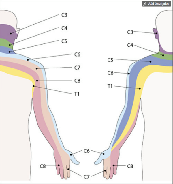 What Type of Thoracic Outlet Syndrome Do You Have and... Why Is This ...