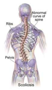 Why Cervical Ribs (Extra Ribs) are Most Likely NOT the Cause of Your ...